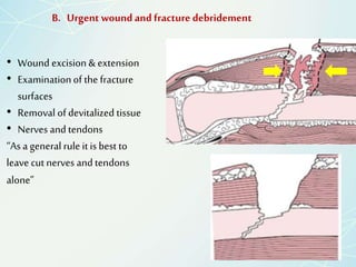 Principles of fractures management | PPTX