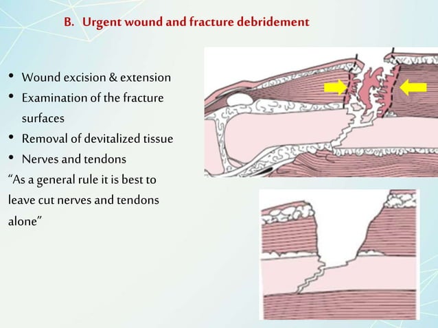 Principles of fractures management | PPTX | First Aid | Injuries