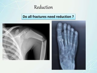 Principles of fractures management | PPTX