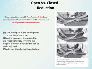 Principles of fractures management | PPTX