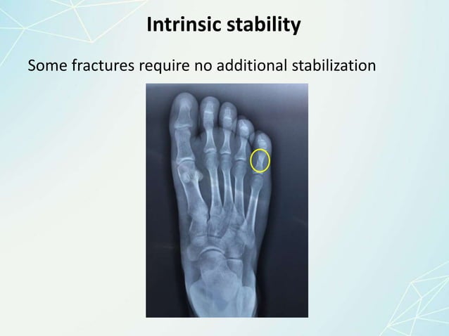 Principles of fractures management | PPTX | First Aid | Injuries