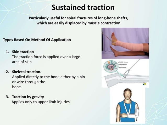 Principles of fractures management | PPTX | First Aid | Injuries
