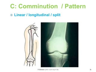 Principles of Fracture Treatment - 1.ppt