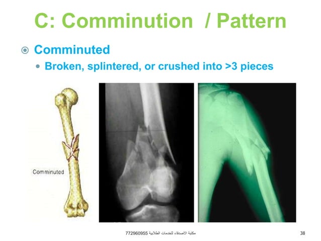Principles of Fracture Treatment - 1.ppt