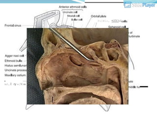 Principles of Functional Endoscopic Sinus Surgery - ppt video online ...