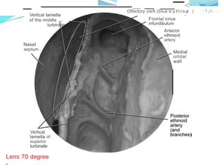 Principles of Functional Endoscopic Sinus Surgery - ppt video online ...