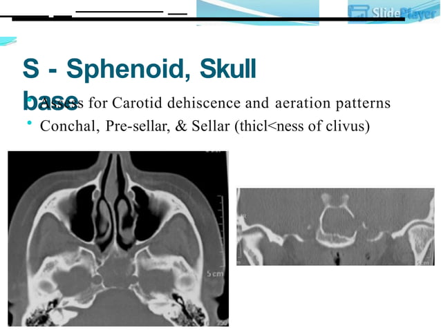 Principles of Functional Endoscopic Sinus Surgery - ppt video online ...