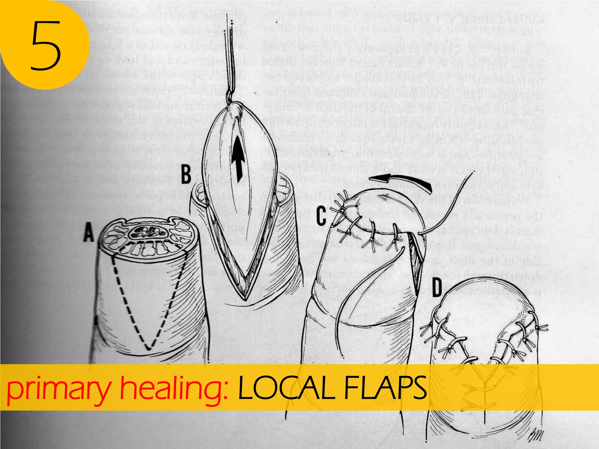 Principles of hand surgery | PDF