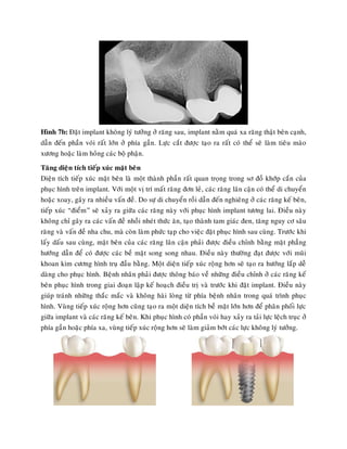 CÁC NGUYÊN TẮC KHỚP CẮN CHO PHỤC HÌNH TRÊN IMPLANT | PDF