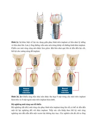 CÁC NGUYÊN TẮC KHỚP CẮN CHO PHỤC HÌNH TRÊN IMPLANT | PDF