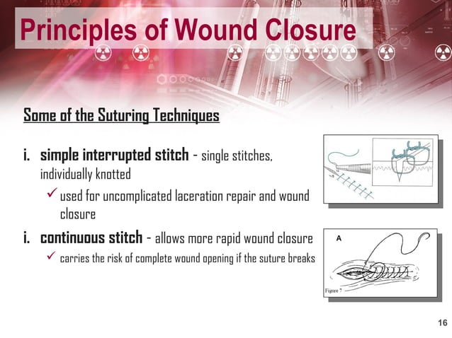 Principles of incision and wound closure | PPT