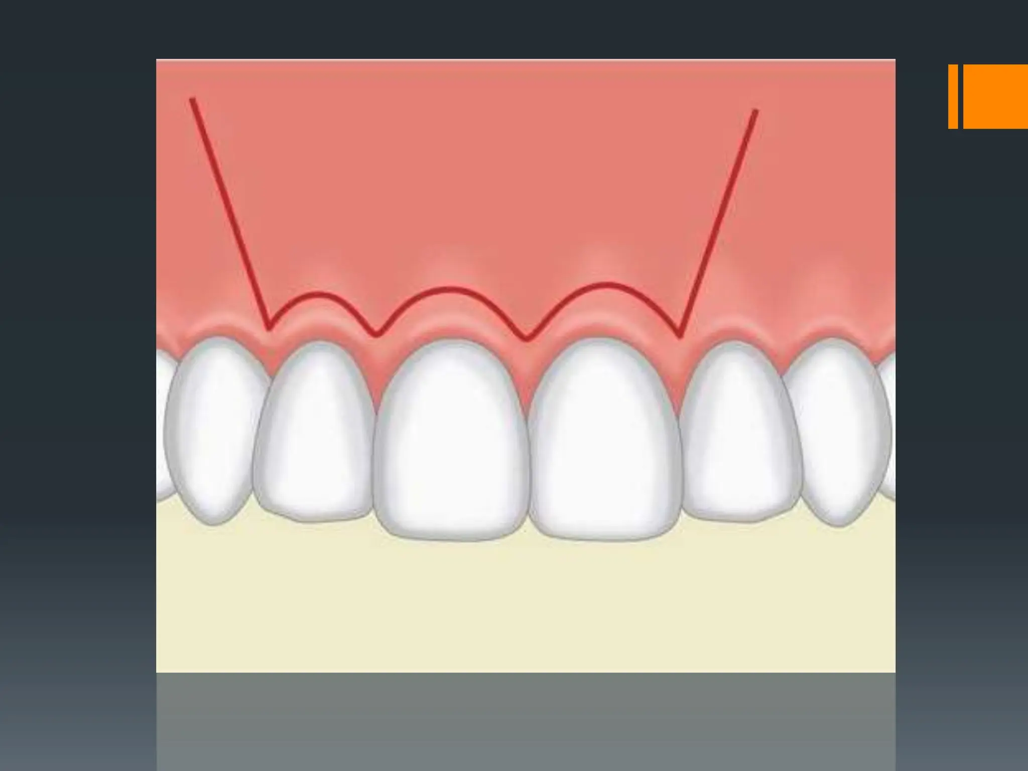 Principles of, incisions in oral surgery.ppt