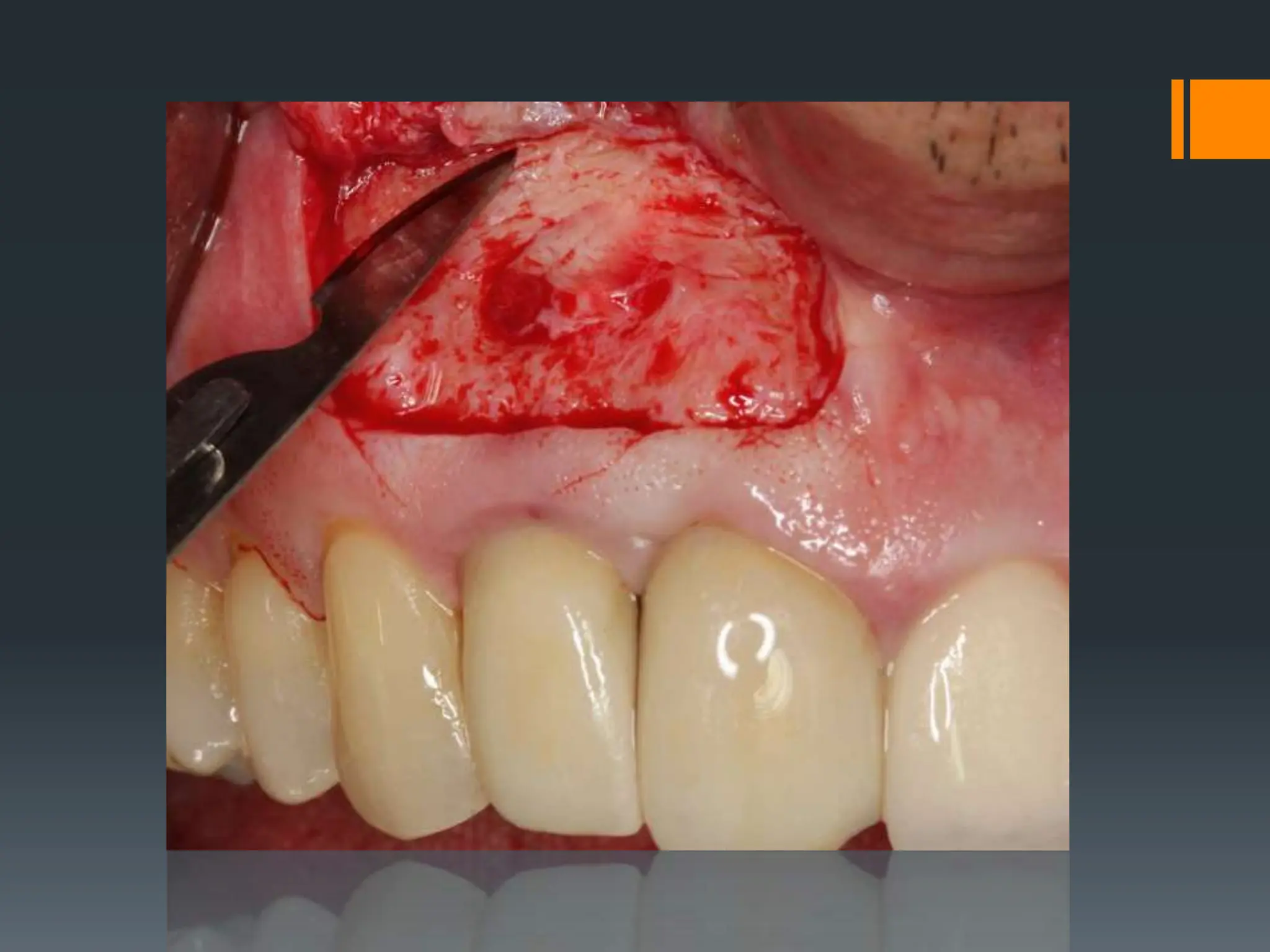 Principles of, incisions in oral surgery.ppt
