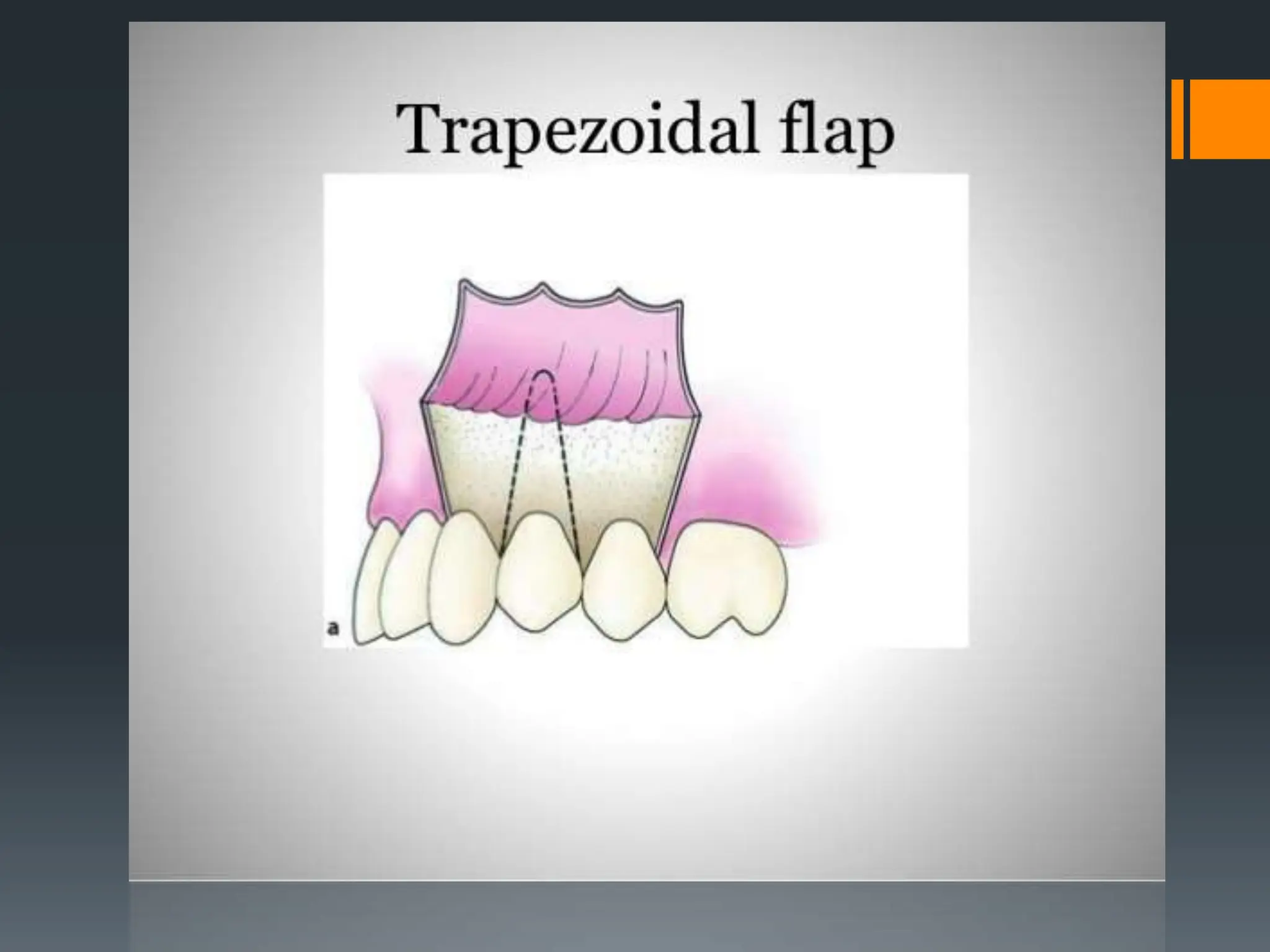 Principles of, incisions in oral surgery.ppt