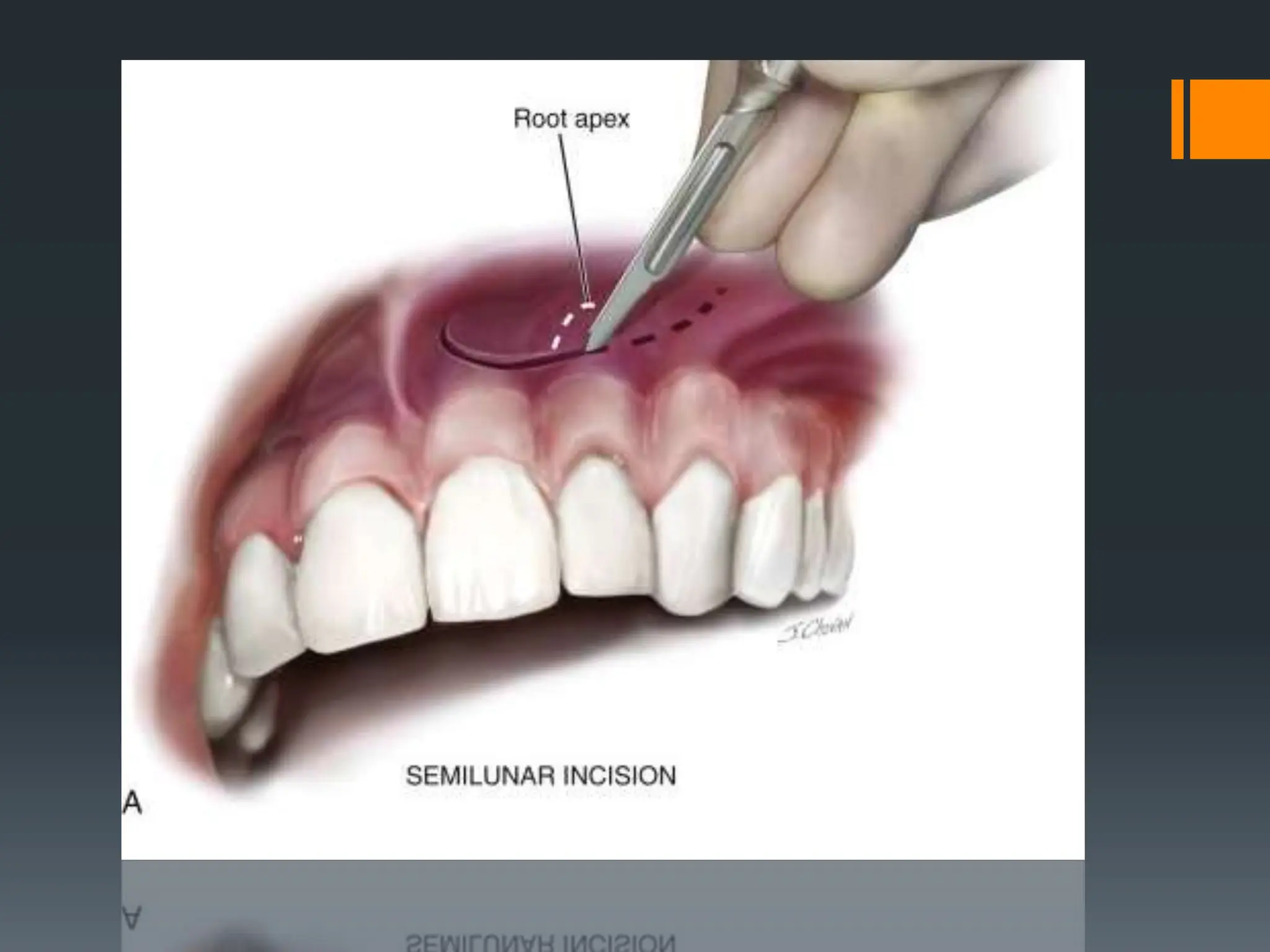 Principles of, incisions in oral surgery.ppt