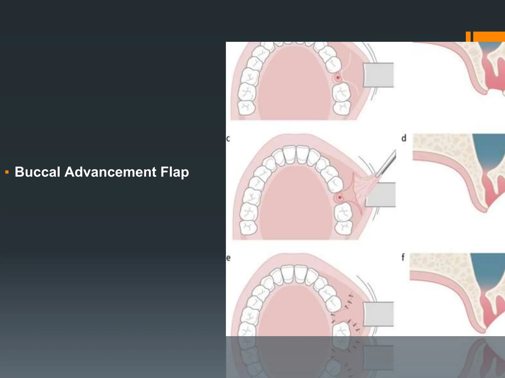 Principles of, incisions in oral surgery.ppt