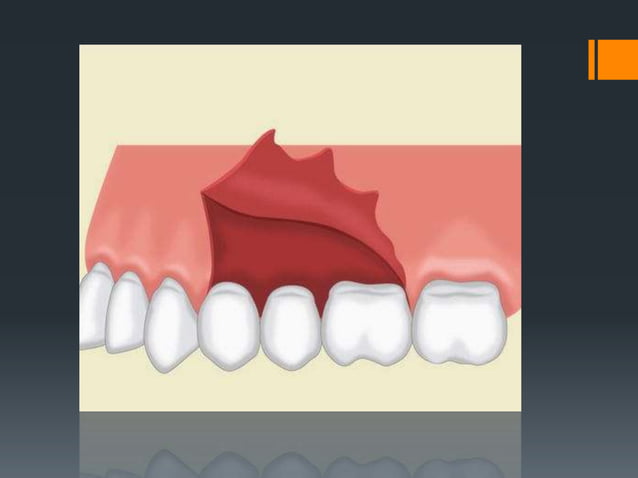 Principles of, incisions in oral surgery.ppt | Dental Health | Diseases ...