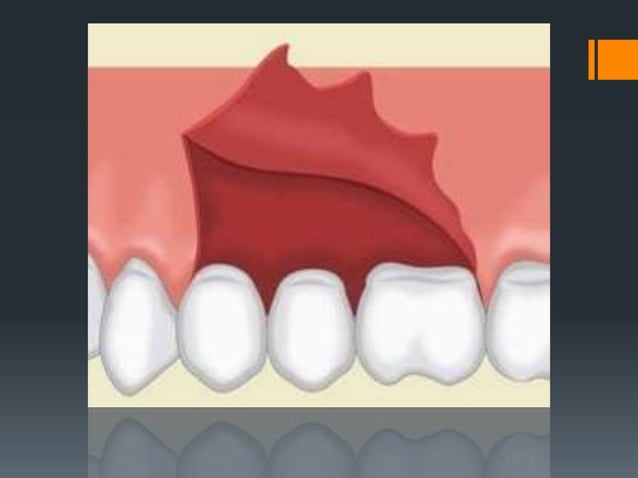 Principles of, incisions in oral surgery.ppt | Dental Health | Diseases ...