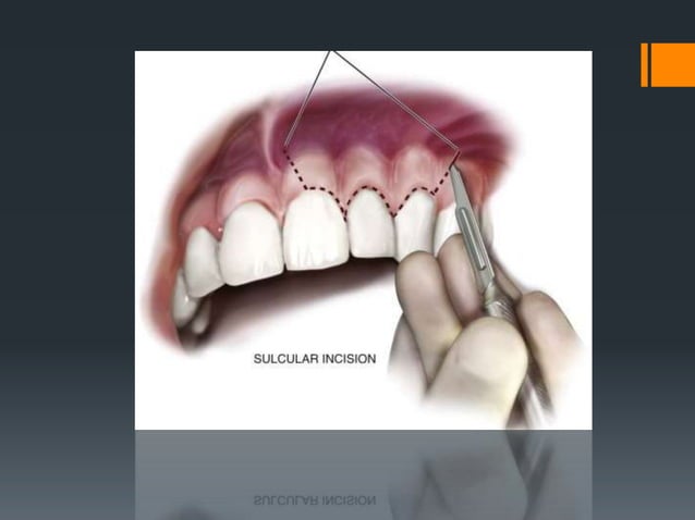 Principles of, incisions in oral surgery.ppt | Dental Health | Diseases ...