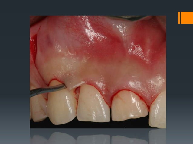 Principles of, incisions in oral surgery.ppt | Dental Health | Diseases ...