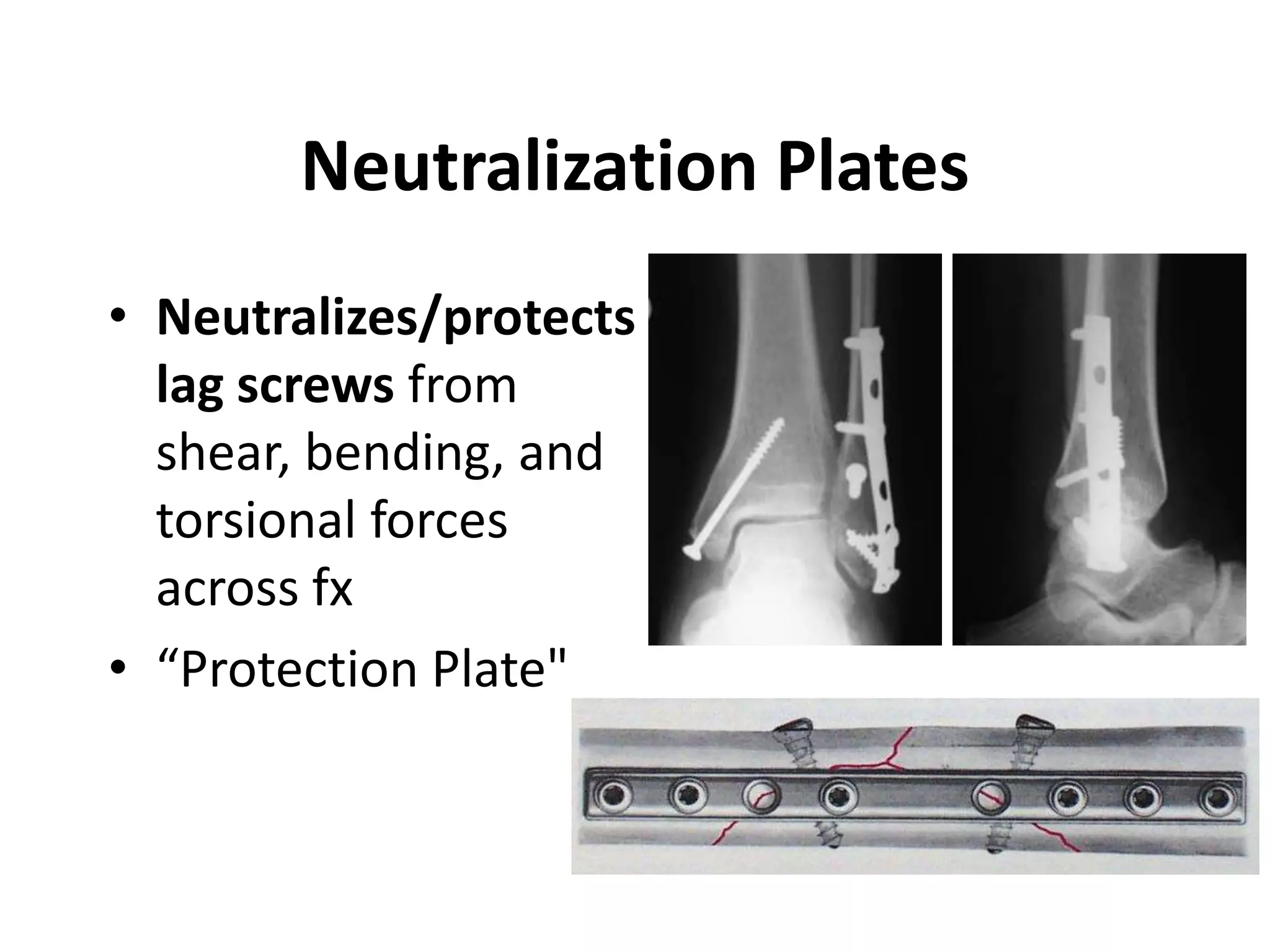 Principles of internal fixation | PPTX