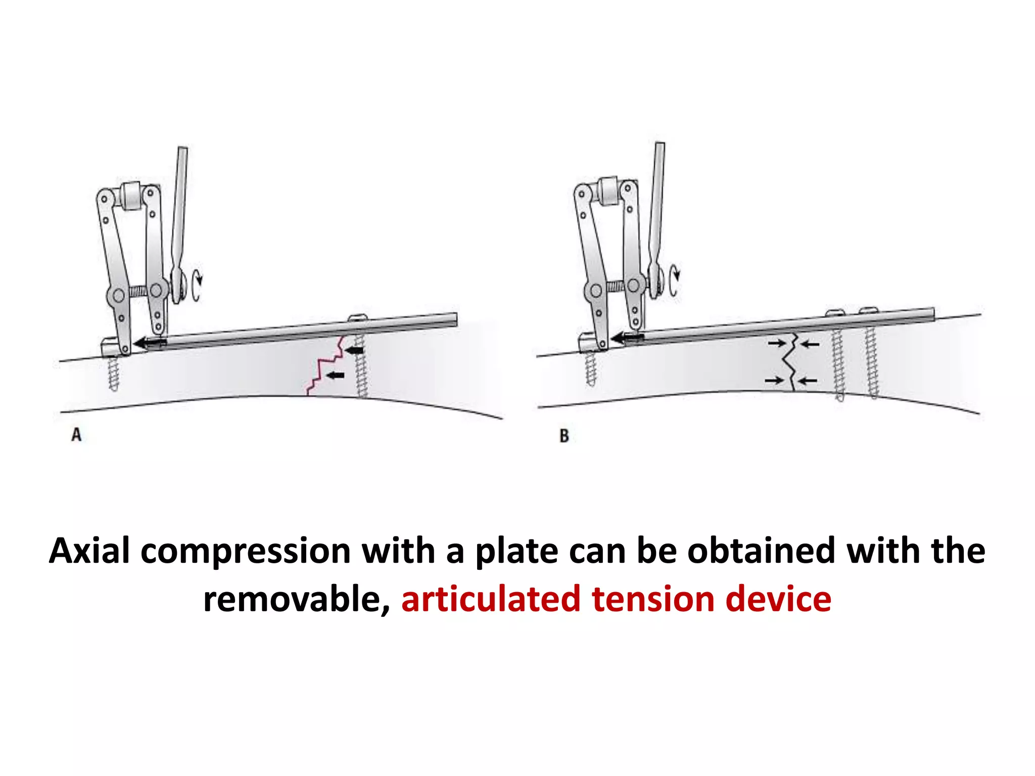 Principles of internal fixation | PPTX