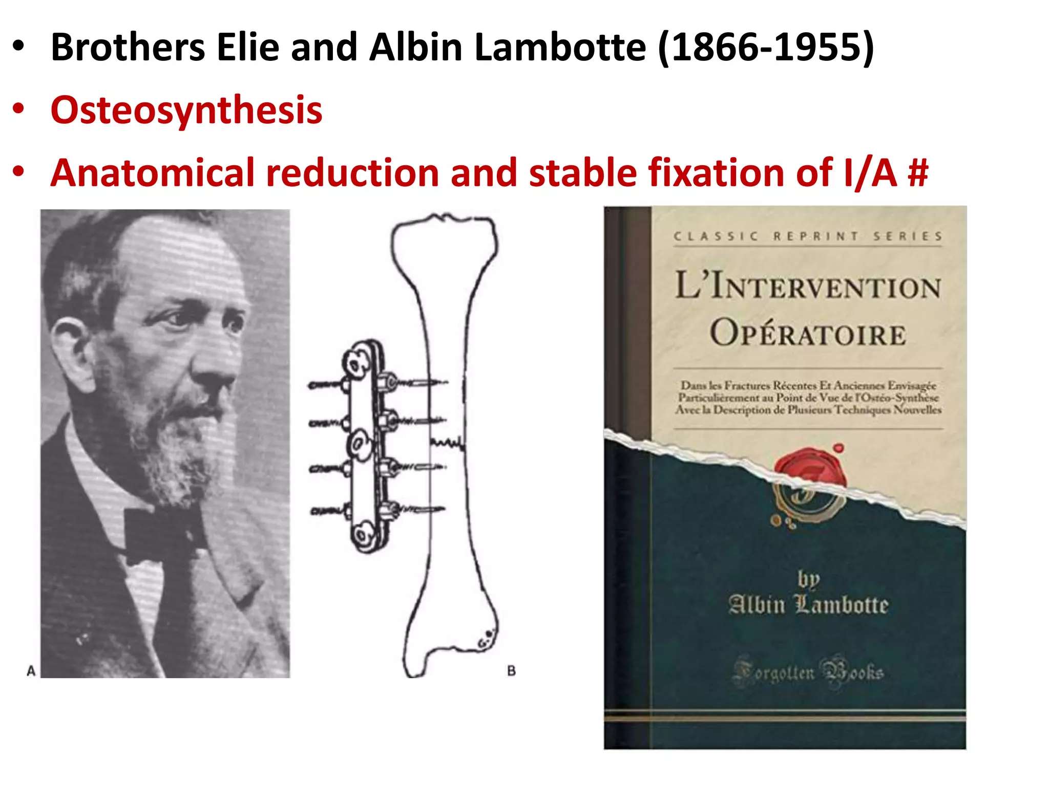 Principles of internal fixation | PPTX