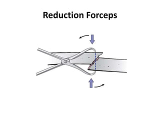 Principles of internal fixation | PPT