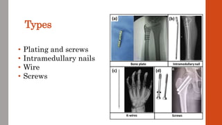 Principles of Internal Fixation.pptx