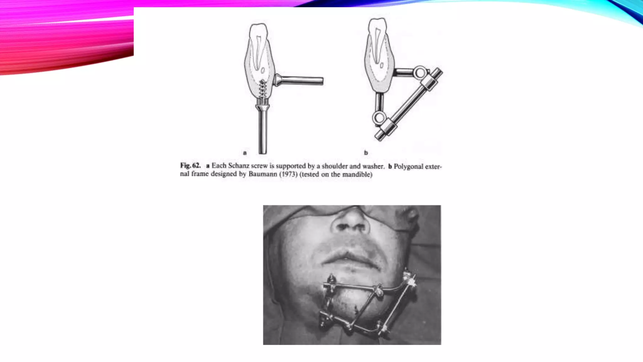 Principles of internal fixation.pptx