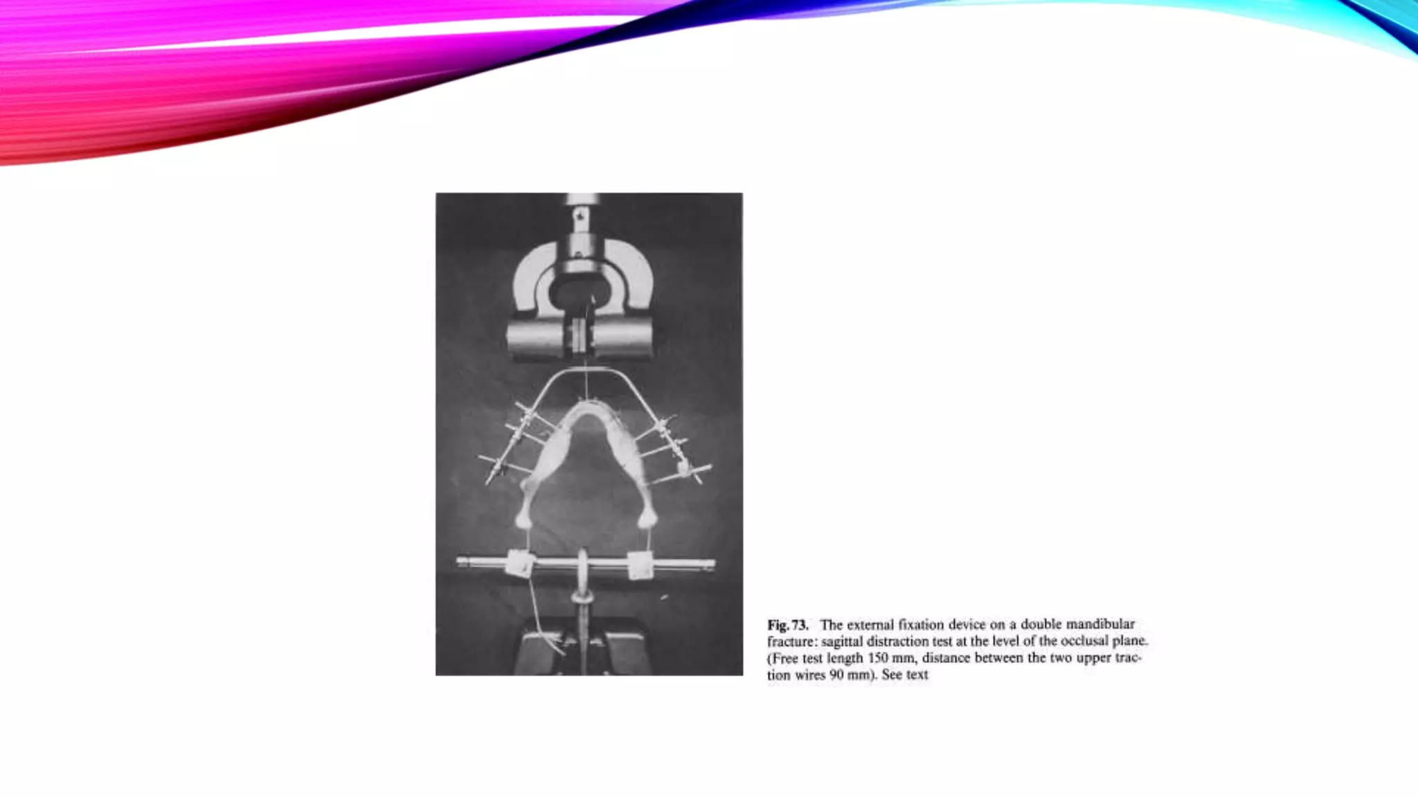 Principles of internal fixation.pptx