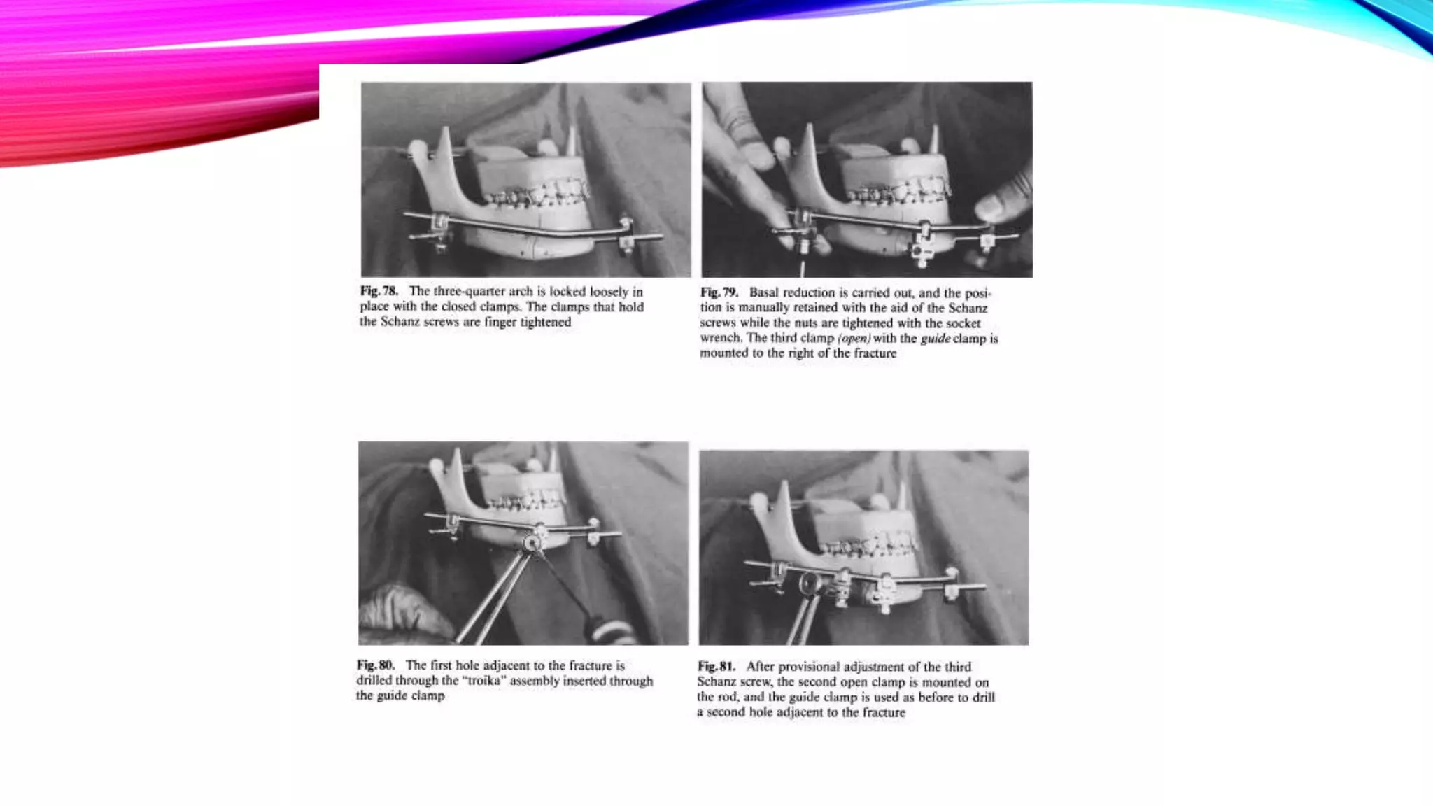 Principles of internal fixation.pptx