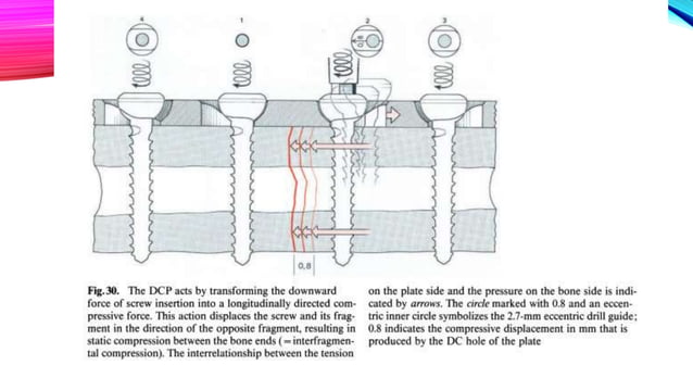 Principles of internal fixation.pptx | First Aid | Injuries