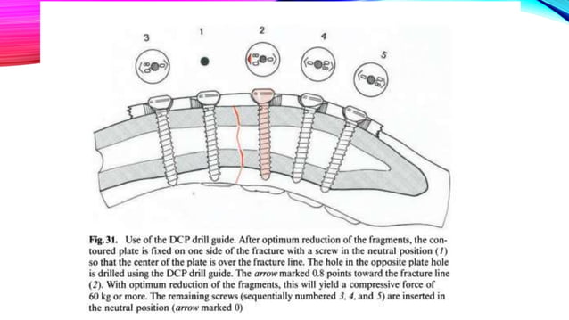 Principles of internal fixation.pptx | First Aid | Injuries