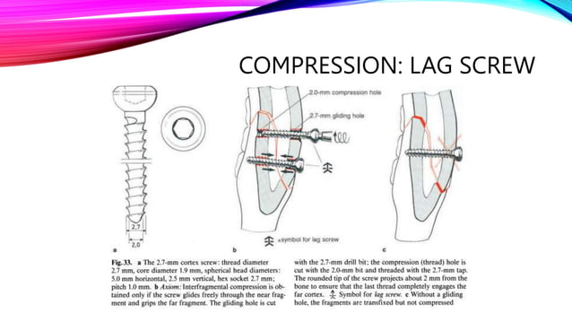 Principles of internal fixation.pptx | First Aid | Injuries