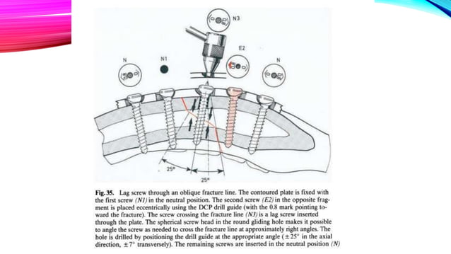 Principles of internal fixation.pptx | First Aid | Injuries