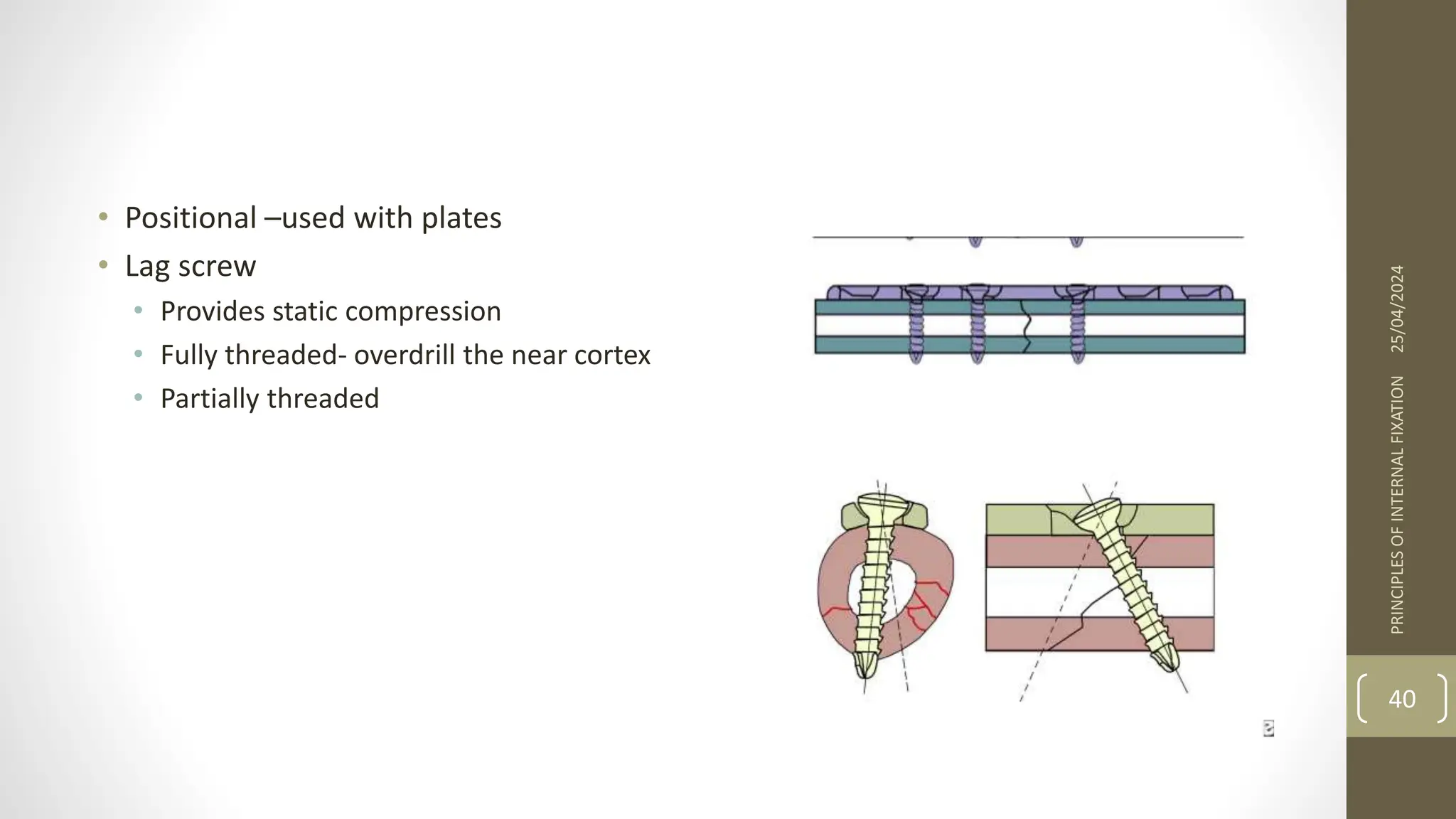 PRINCIPLES OF INTERNAL FIXATIONs(1).pptx