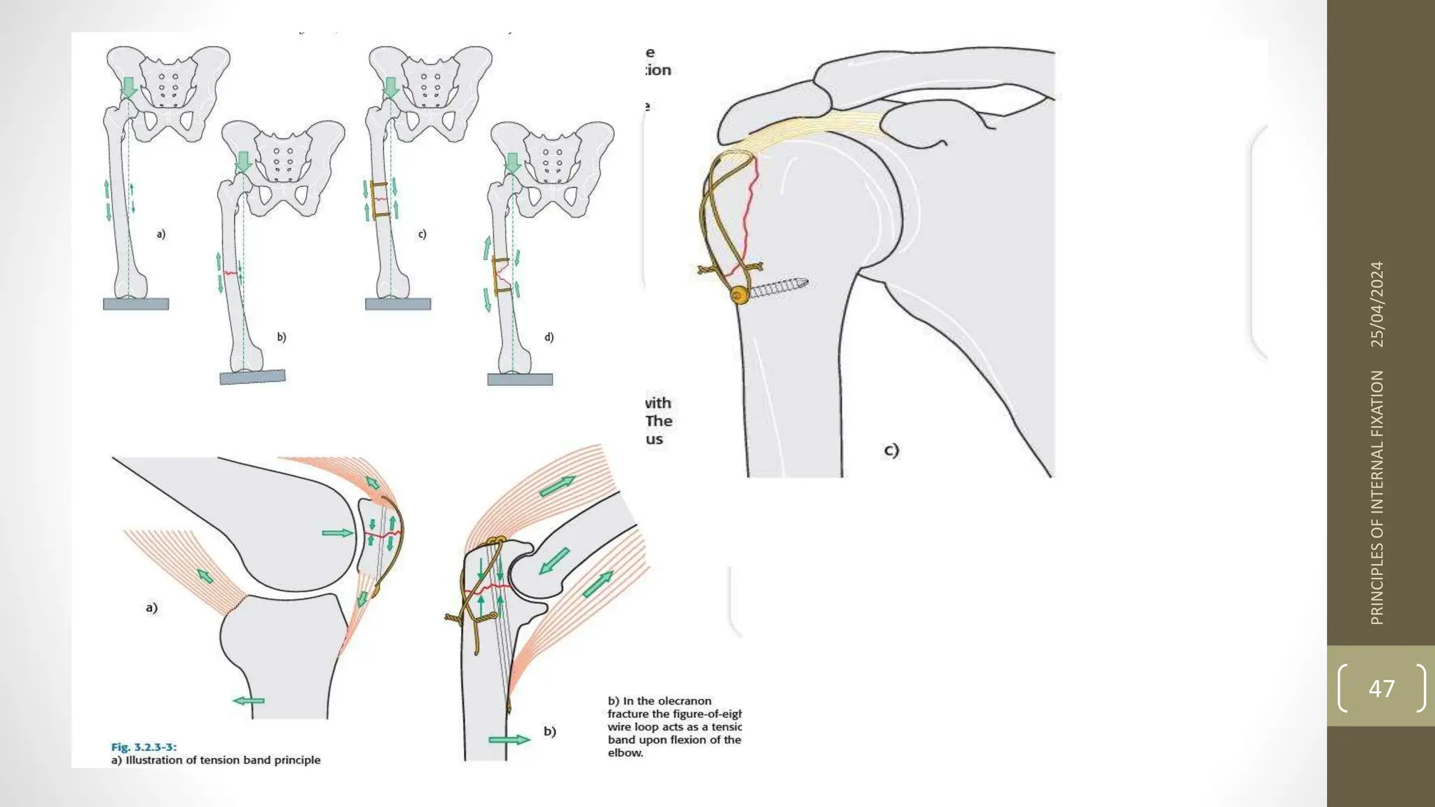 PRINCIPLES OF INTERNAL FIXATIONs(1).pptx