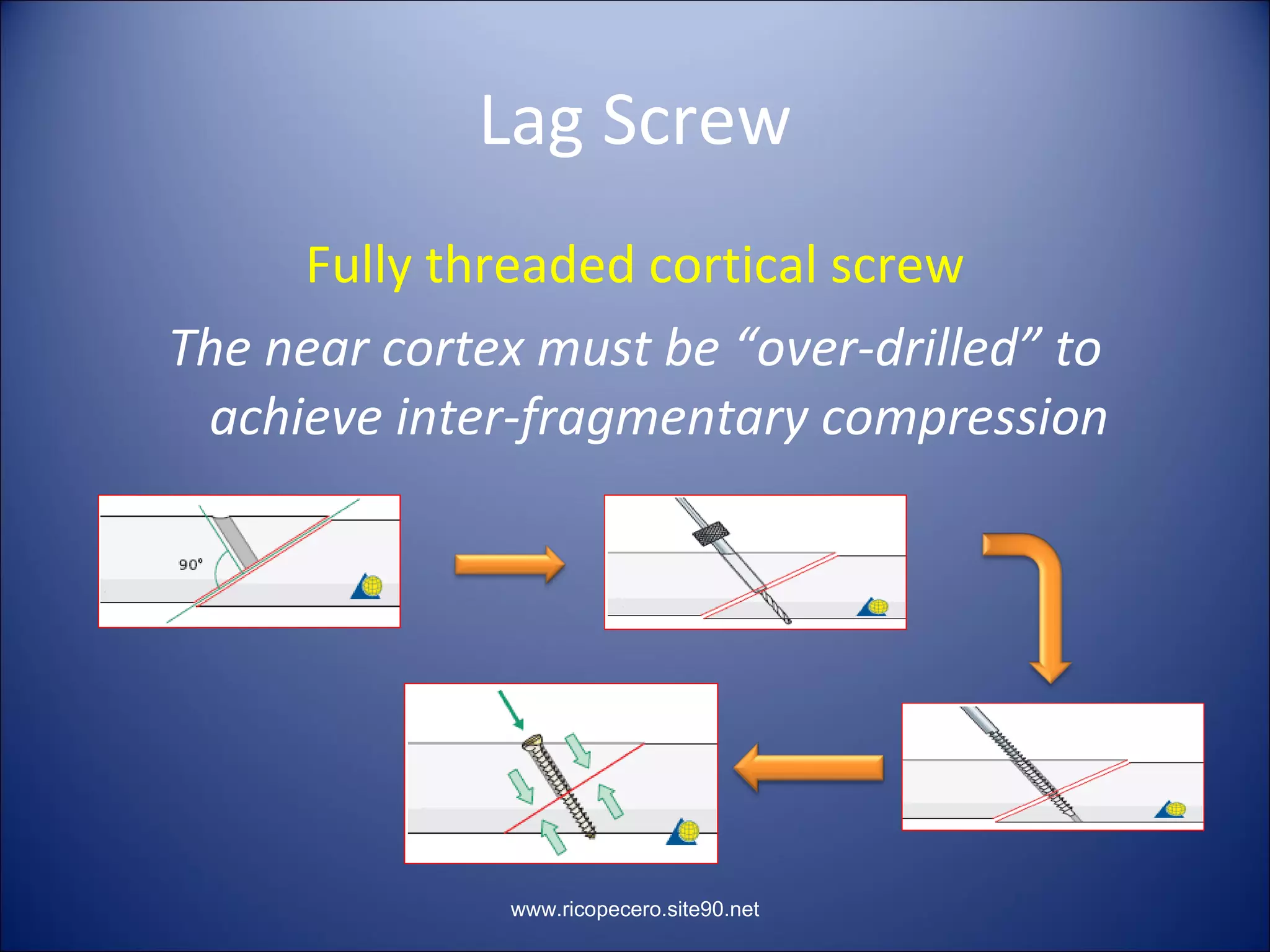 Principles Of Lag Screw + Platting | PPT