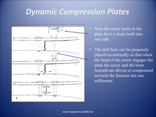 Principles Of Lag Screw + Platting | PPT