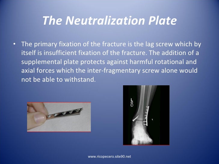 Principles Of Lag Screw + Platting