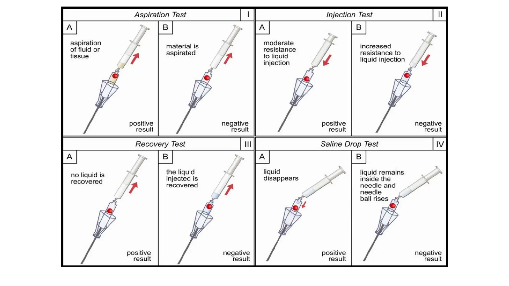 Principles of Laparoscopy and Procedure of Laparoscopic Varicocelectomy ...