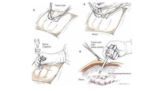 Principles of Laparoscopy and Procedure of Laparoscopic Varicocelectomy ...