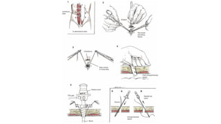 Principles of Laparoscopy and Procedure of Laparoscopic Varicocelectomy ...