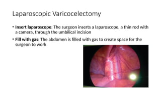 Principles of Laparoscopy and Procedure of Laparoscopic Varicocelectomy ...
