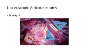 Principles of Laparoscopy and Procedure of Laparoscopic Varicocelectomy ...