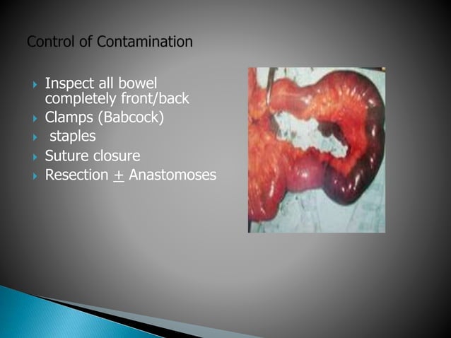 Principles of laparotomy for trauma | PPTX | First Aid | Injuries