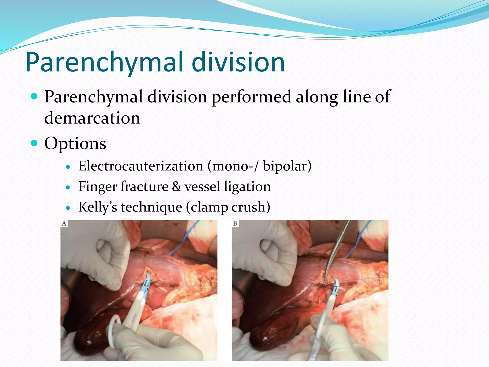 Principles of liver resection.pptx