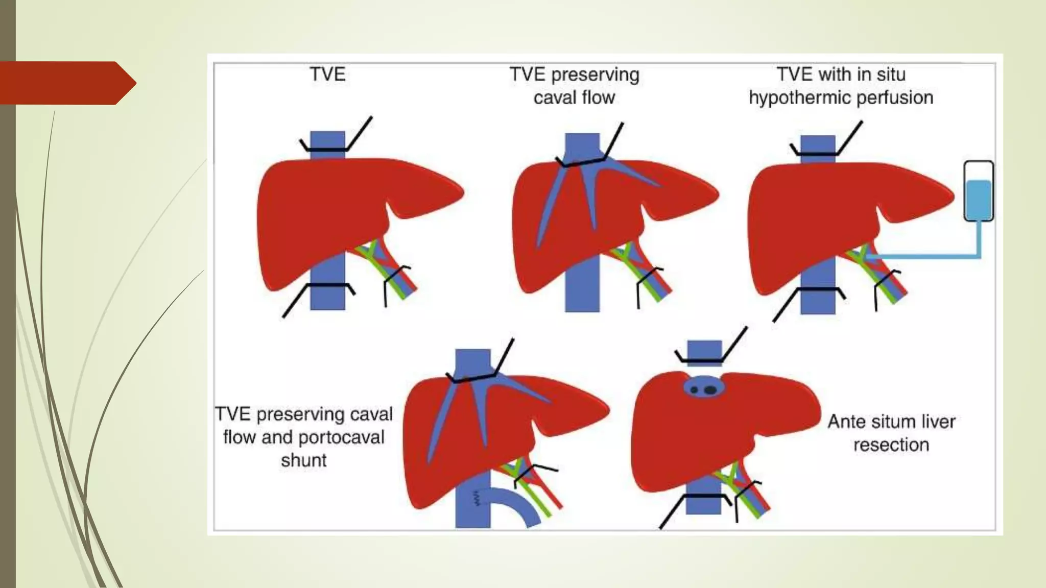 Principles of liver surgery.pptx