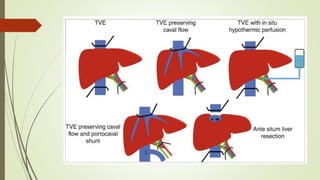 Principles of liver surgery.pptx